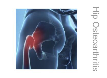 OA hip patient | the good exercise guide